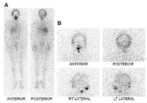 Radioactive Iodine Scan