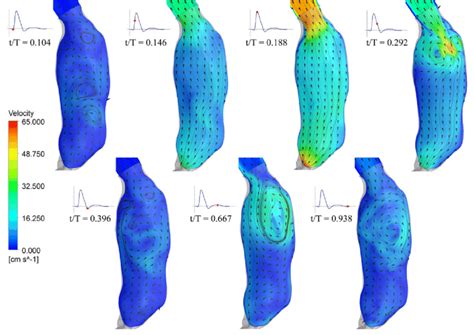 Transient Velocity Vectors On Axial Plane Of Aaa Sac Download
