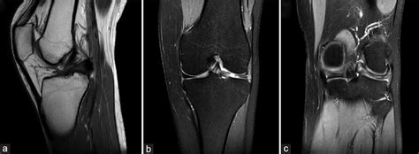 Regeneration Of A Discoid Meniscus After Saucerization Rein
