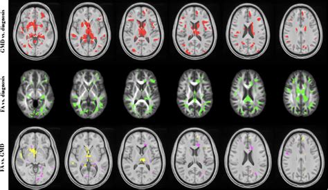 Sparse Canonical Correlation Analysis Scca Of T1 Weighted Mp‐rage And Download Scientific