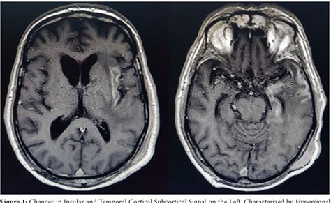 Figure 1 From Herpetic Encephalitis Associated With Multiple Myeloma