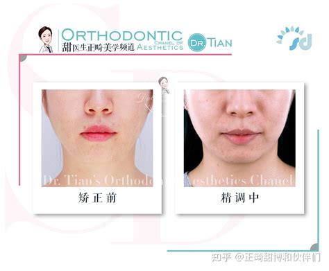 郑州牙齿矫正 嘴凸 牙齿深覆合 矫正案例 ， 侧貌改善 已经有下巴了 知乎
