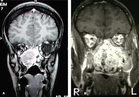 Ethmoid And Anterior Skull Base Neoplasms Ento Key
