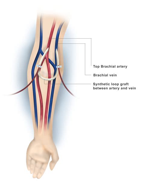 Creation Of Dialysis Fistula Graft And Placement Of Peritoneal Dialysis Catheters Dubai Dr