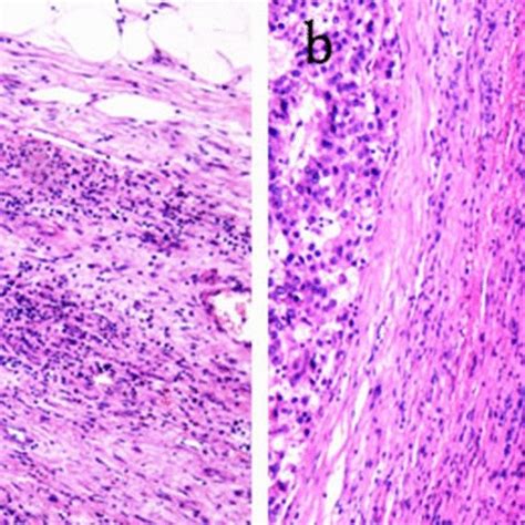 Mvi Classification And Its Presence In Hcc Mvi Be Evaluated In All