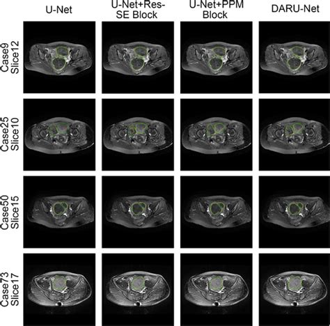 Comparison Of Segmentation Of U‐net U‐net With Res‐se Block U‐net