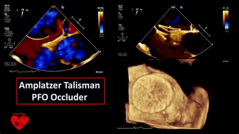 Zukaï Chati On Linkedin Tias Ait Pfo Fop Pfooccluder Heart Brain