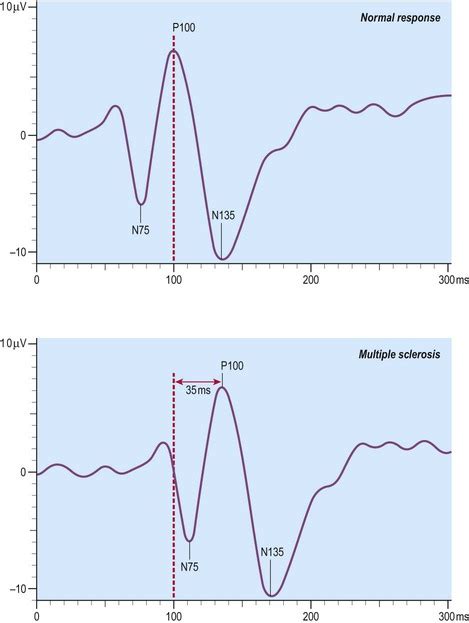Multiple Sclerosis Neupsy Key