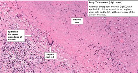 Lung Tuberculosis Nus Pathweb Nus Pathweb