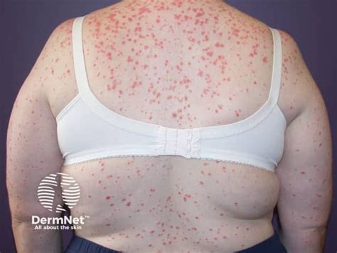 Chronic Plaque Psoriasis Causes Symptoms And Treatment