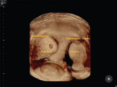 Timely Identification Of Pregnancy In Noncommunicating Horn Of