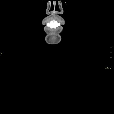 Ct Neck Contrast Rad Ct Guide