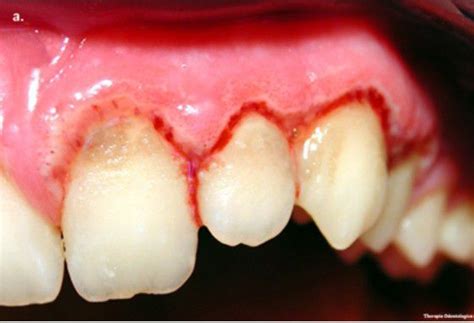 Acute Necrotizing Ulcerative Gingivitis Medizzy