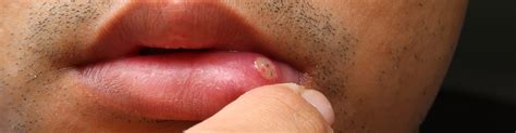 Canker Sores Explained Causes Duration Quick Relief
