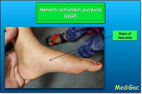 Henoch Schonlein Purpurahsp Clinical Features Pathophysiology
