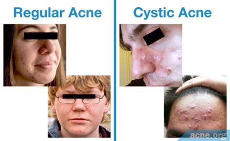 Nodular Acne Vs Cystic Acne