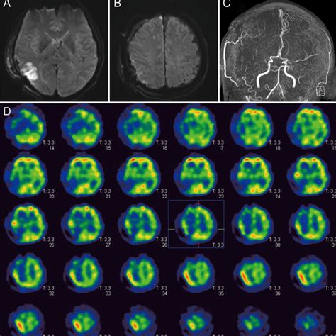 Postoperative Radiological Examinations A Dwi Showed Acute Cerebral Download Scientific