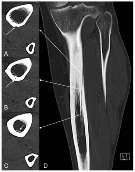 The Anatomy Of The Tibial Nutrient Artery Canal—an Investigation Of 106