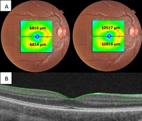 A Macular Ganglion Cell Layer Gcl Average Values Of Download Scientific Diagram