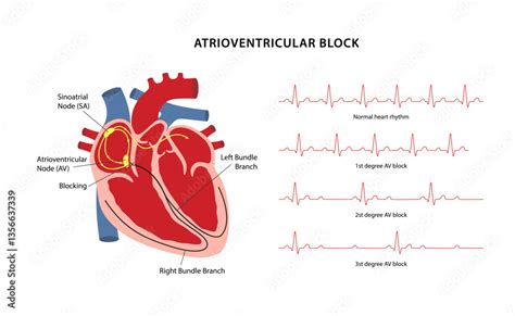Atrioventricular Block Сardiac Conduction System Diagram With Main Captions Cardiograms Of