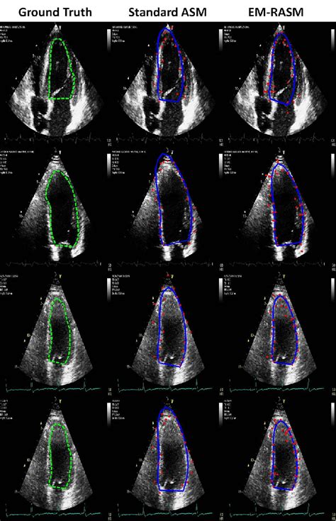 Segmentation Of The Left Ventricle In Ultrasound Images The Green