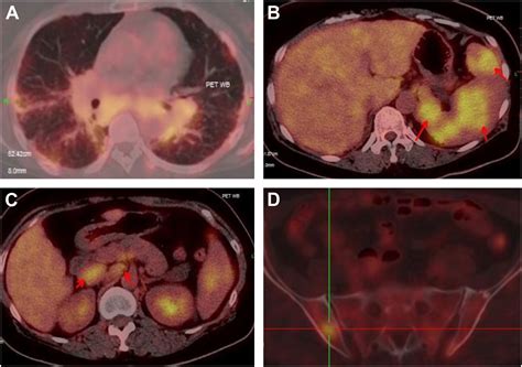 Diagnosis Of Pulmonary Sarcoidosis Clinics In Chest Medicine