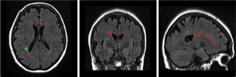 Segmentation Of White Matter Lesions In An Exemplary Subject Of The Download Scientific Diagram