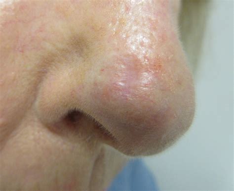 Skin Cancer Types On Nose