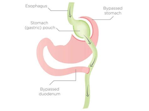 Total Gastrectomy