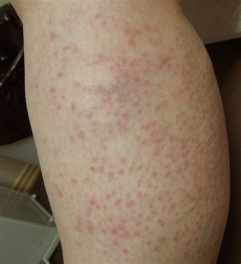 👉 Viral Exanthem Pictures Treatment Symptoms Causes January 2022