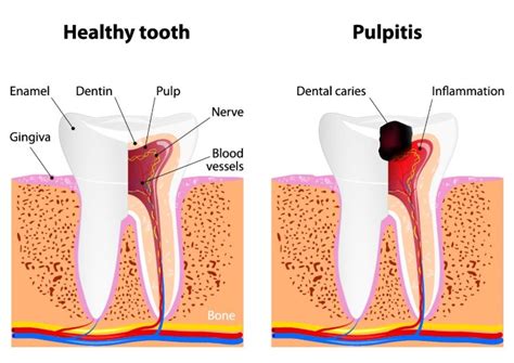 Sensitivity After A Filling Windsor Dentists