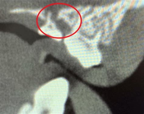 Persistent Deciduous Teeth Unerupted Permanent Teeth Dentigerous Cyst Under Erupted Permanent