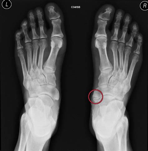 Accessory Bone Os Navicularis Consultant Podiatric Surgeon Jonathan Larholt