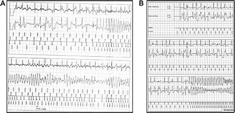 A Probands Dual Chamber Implantable Cardioverter Defibrillator Icd Download Scientific