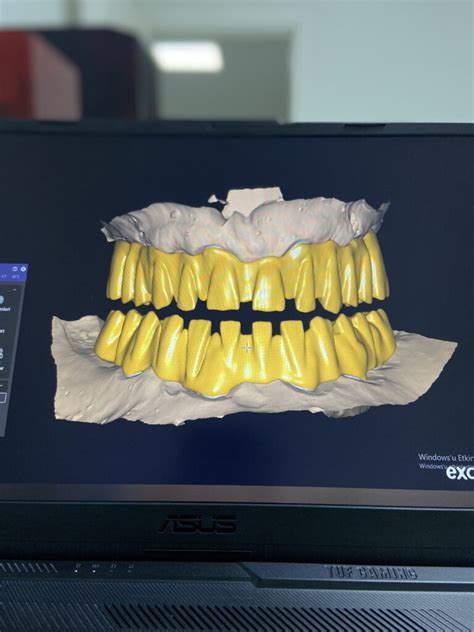 Exocad tasarım yapılır stl Dentalkariyer