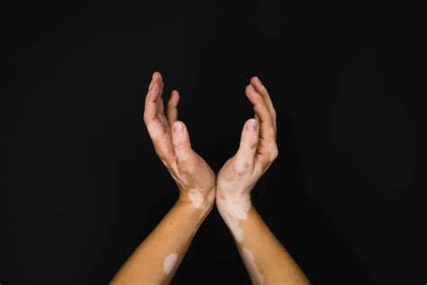 Album De Vitiligo Vitiligo Archives Consultorsalud