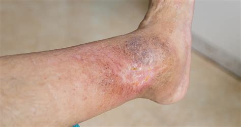 Leg Vein Ulcers Causes And Healing Solutions Minneapolis Vein Center