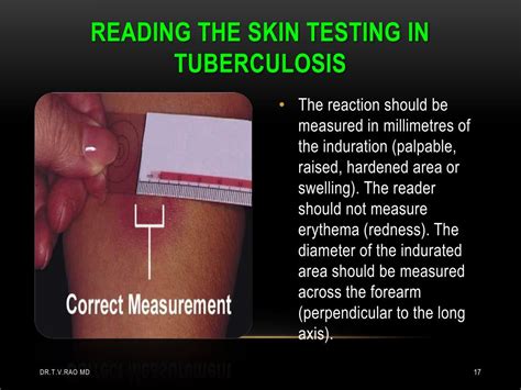 Ppt Tuberculin Skin Testing Mantoux Tuberculin Skin Test Powerpoint