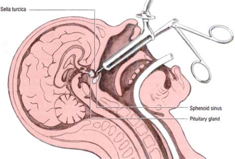 Hypophysectomy Nurse Key