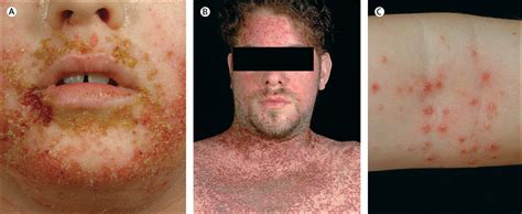 Atopic Dermatitis The Lancet