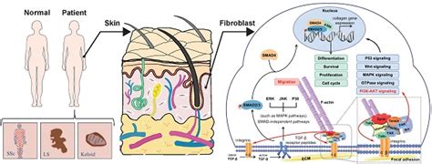 Enhancement Of Zyxin Promotes Skin Fibrosis By Regulating Fakpi3kakt