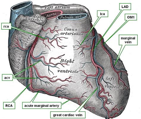 Left Anterior Descending Artery Blockage