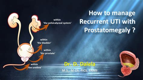 How To Manage Recurrent Uti With Prostatomegaly Youtube