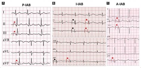Neurological Complications Of Interatrial Blocks And Bayes Syndrome