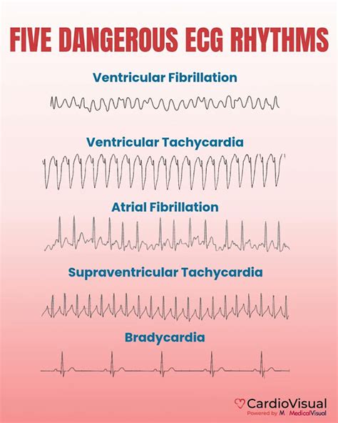 🫀 Lets Review The Five Critical Ecg Rhythms Cardiology Hearthealth