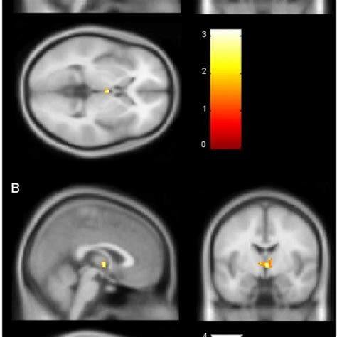 Sex Differences In Hypothalamus Activation A Hypothalamus Activation Download Scientific