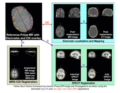 Applications Of Rigid And Nonrigid Registration In Neurosurgical Download Scientific Diagram