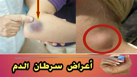 اعراض سرطان الدم صور جميلة