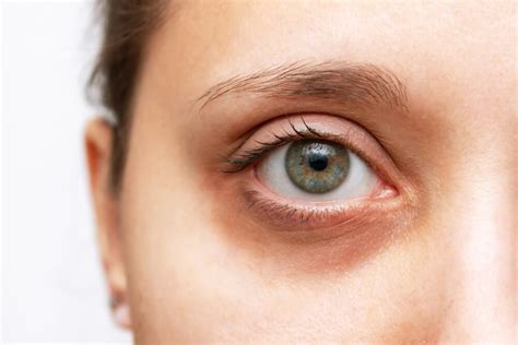 How To Get Rid Of Dark Circles Under Your Eyes Vine Vera