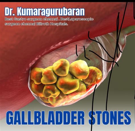 Understanding Anal Fissure Symptoms Best Gastro Doctor In Chennai